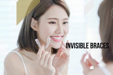 Invisible Braces: Types, Pros and Cons, and How They Work